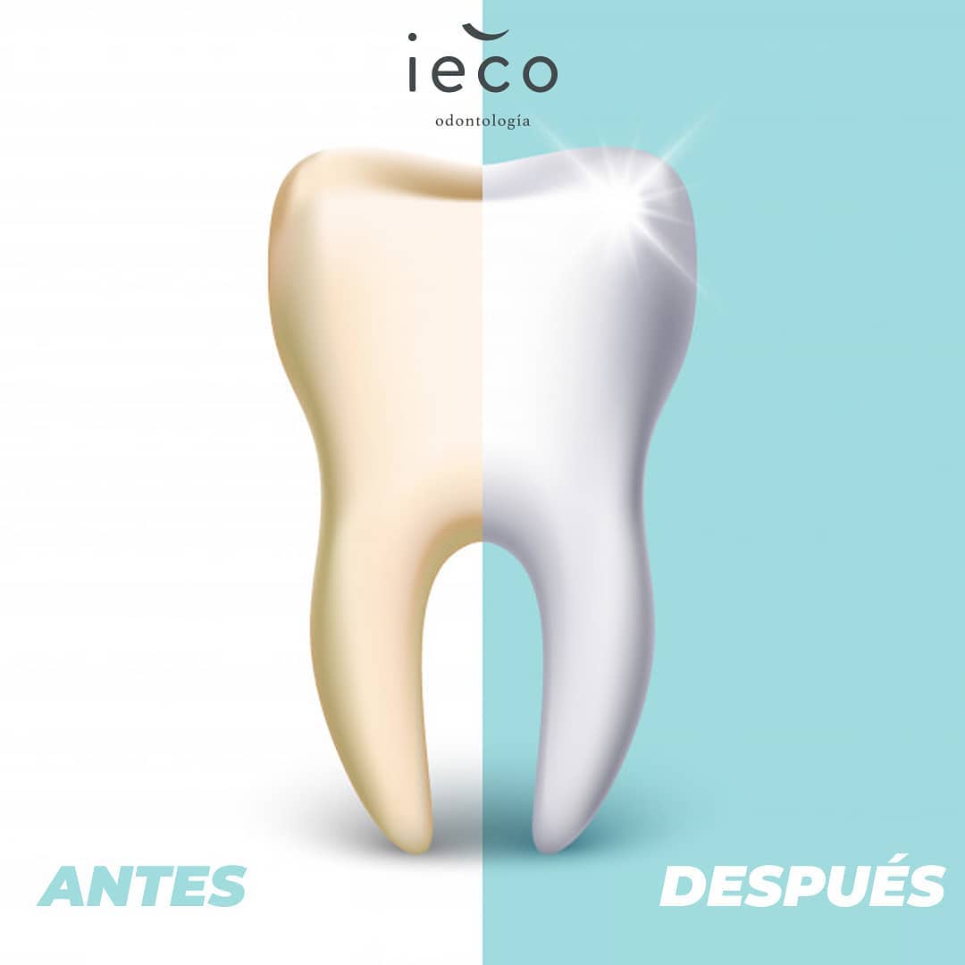 Dientes amarillentos ¿Momento de un blanqueamiento? - IECO